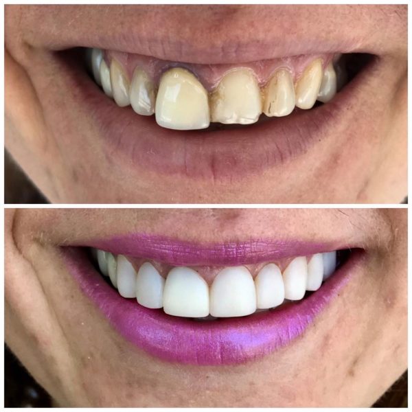 Veneers in Tijuana - Smile Tijuana Dentist Cosmetic Dentistry